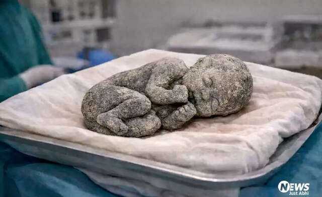 A shocking case of lithopedion: Woman carries dead fetus for 15 years
