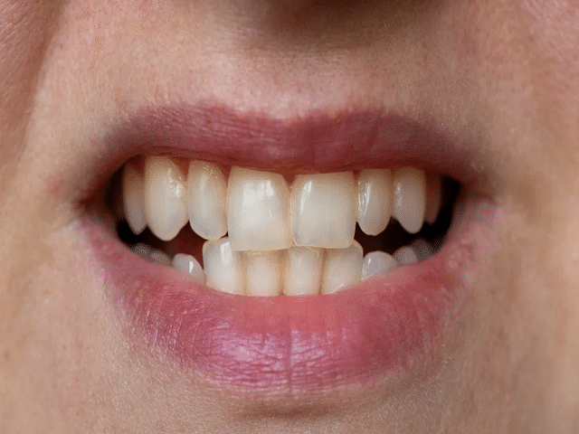Why do teeth turn yellow even if you brush daily? Click here to know