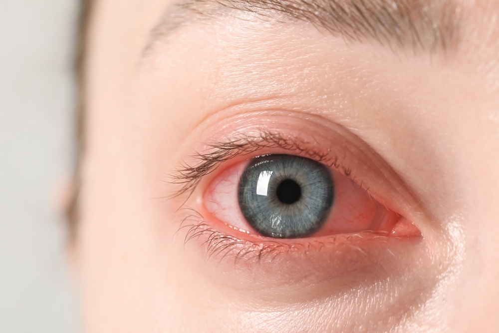 Is dry eye sneaking up on you? Look for these signs