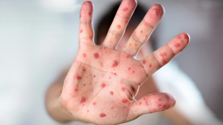 SC measles outbreak remains stalled just short of 1,000 cases