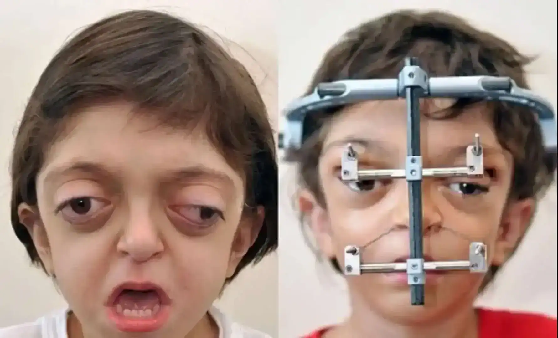 Reconstrucción craniofacial mejora la función respiratoria y visual de ...