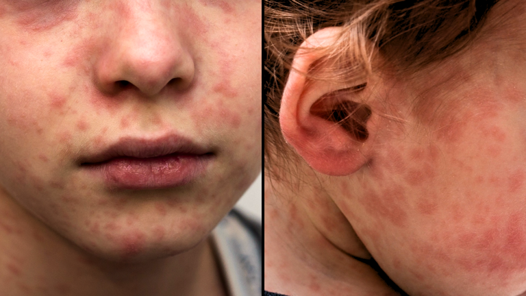 US measles surge explodes past 1,100 cases, doctors warn deaths could ...