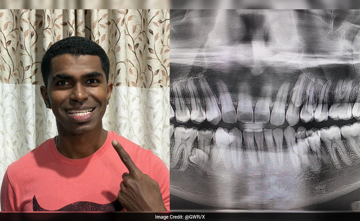 Malaysian man with 42 teeth sets world record for most teeth in mouth