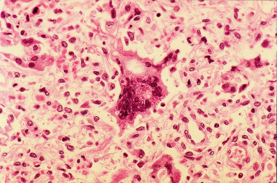 4 more Colorado measles cases confirmed in school outbreak, exposure ...