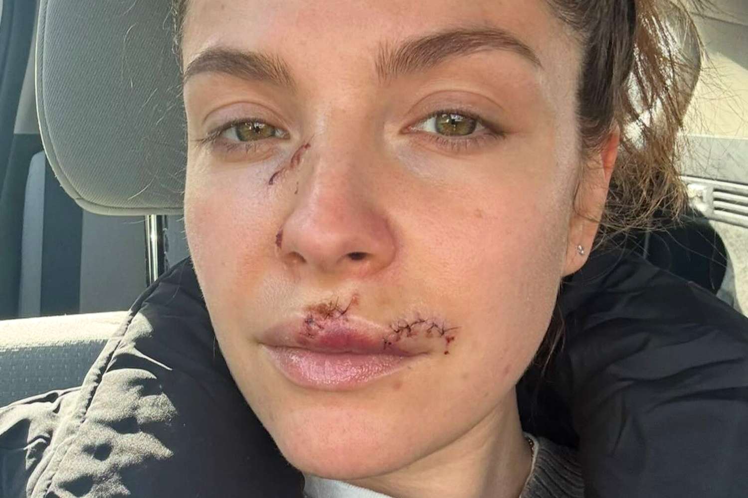 The Good Doctor star Paige Spara reveals horrific facial injuries after ...