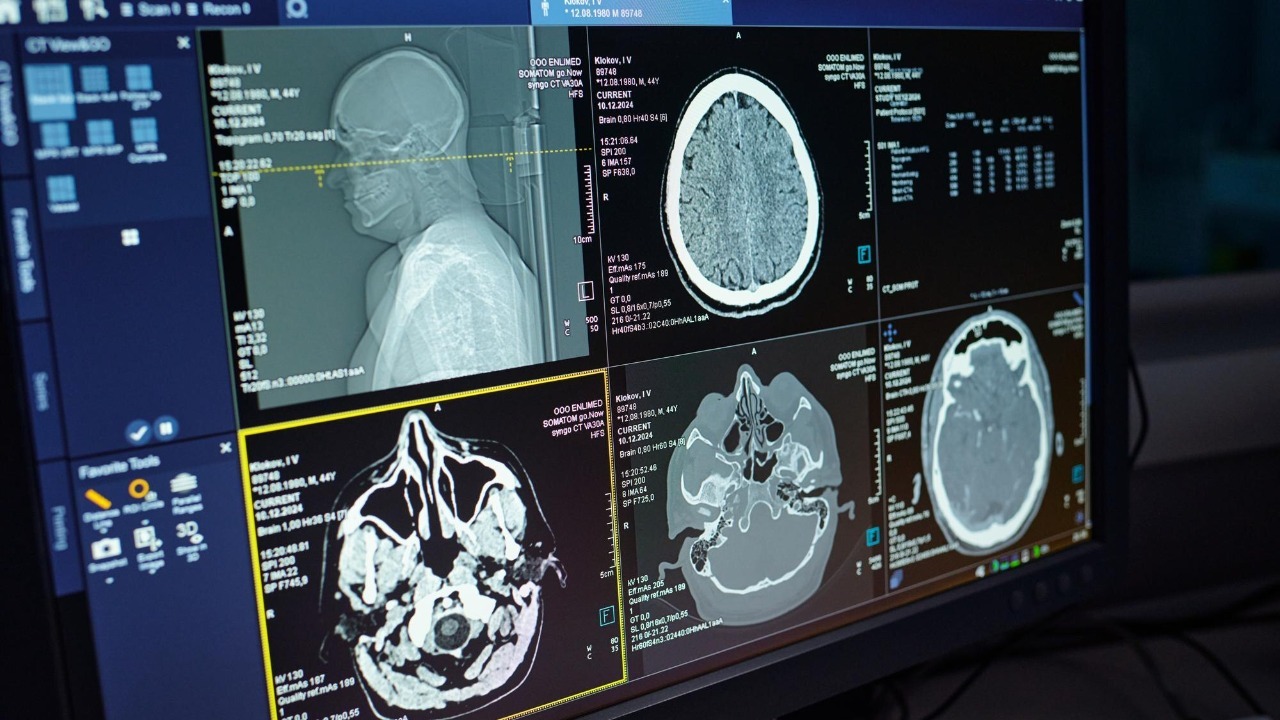 Brain scans on psychedelics reveal how wild visual hallucinations form