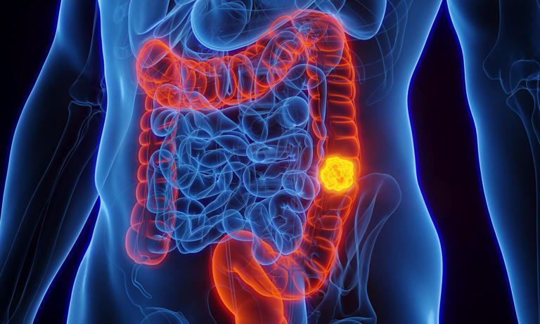Doctors share 11 tips to lower your risk of bowel cancer - as cases ...