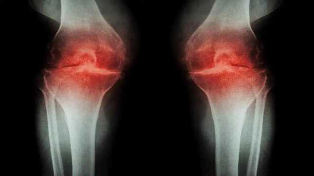 Understanding the impact of stress on bone health