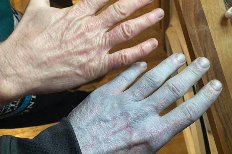 Man looked like 'an Avatar' and was rushed to hospital after waking up ...