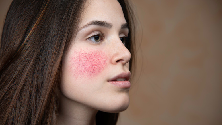 5 tips for preventing rosacea flare-ups
