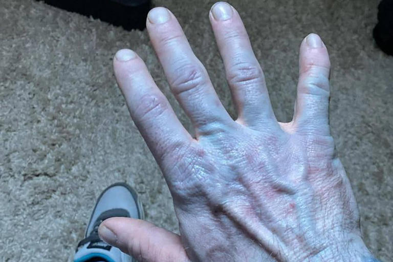 Midlands man turns blue from new bedsheets and rushed to A&E in panic