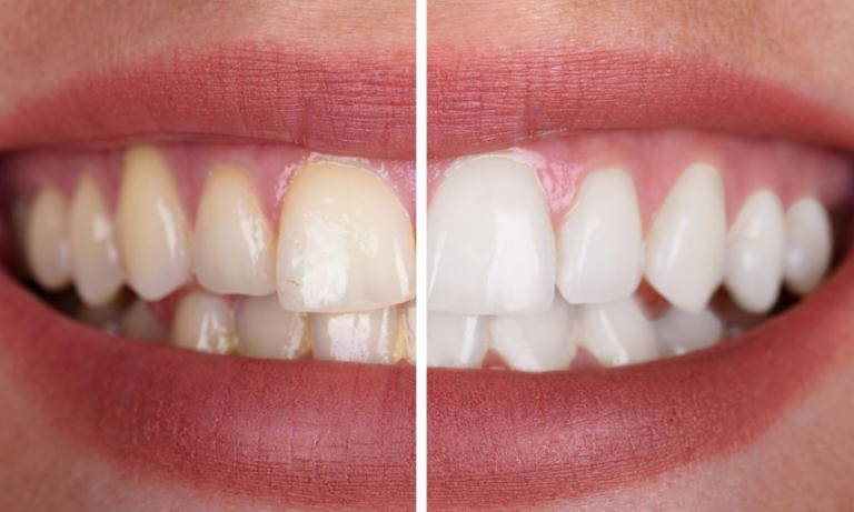 3 ingredientes para quitar la placa y el sarro de los dientes