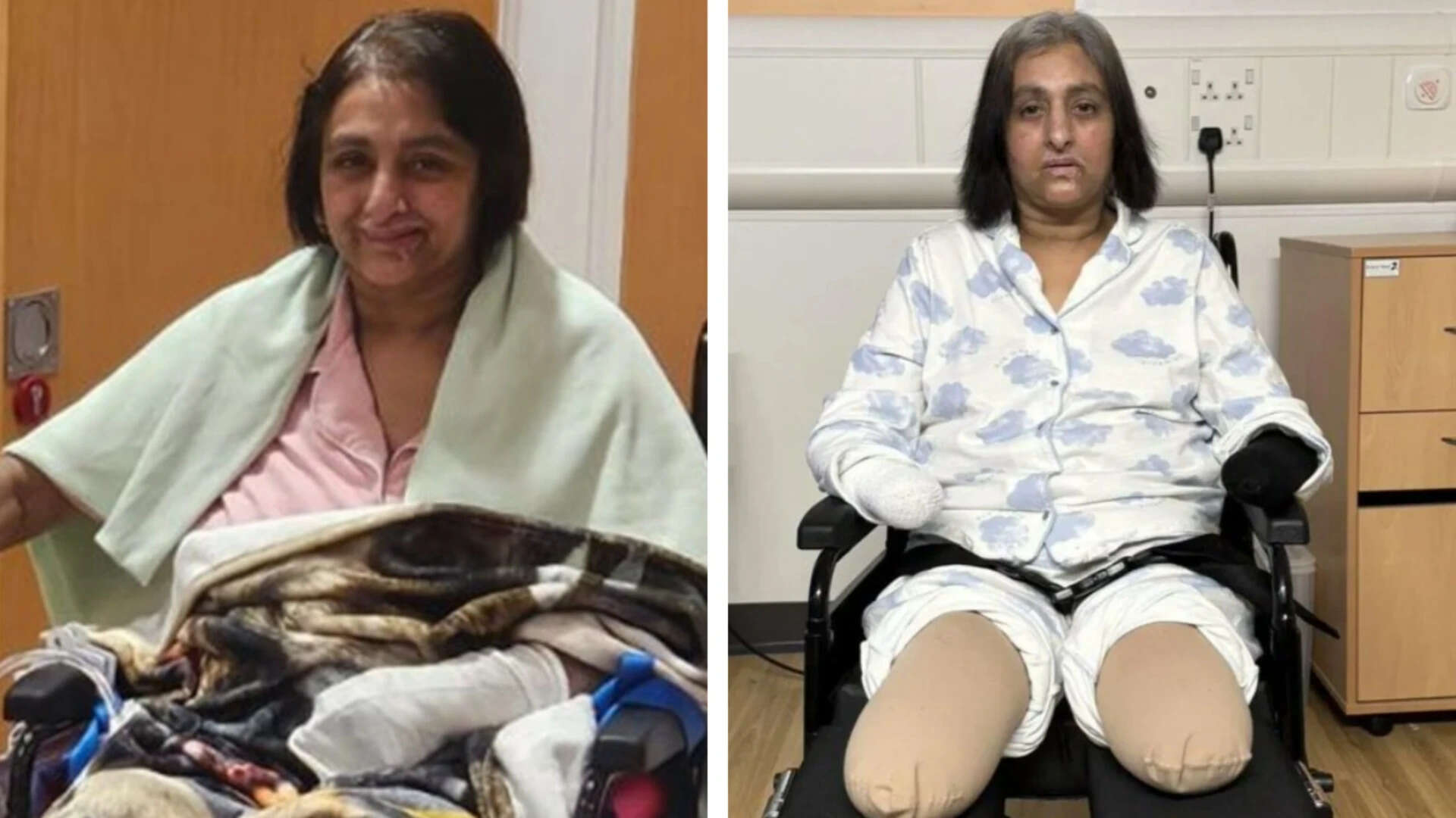Indian-origin woman in England loses all four limbs after dog lick ...
