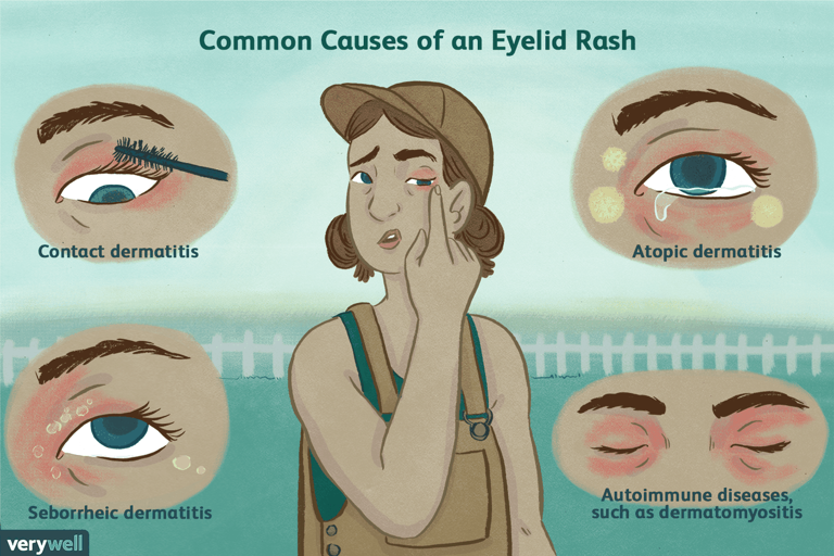 6 causes of a rash on your eyelid and how to treat it