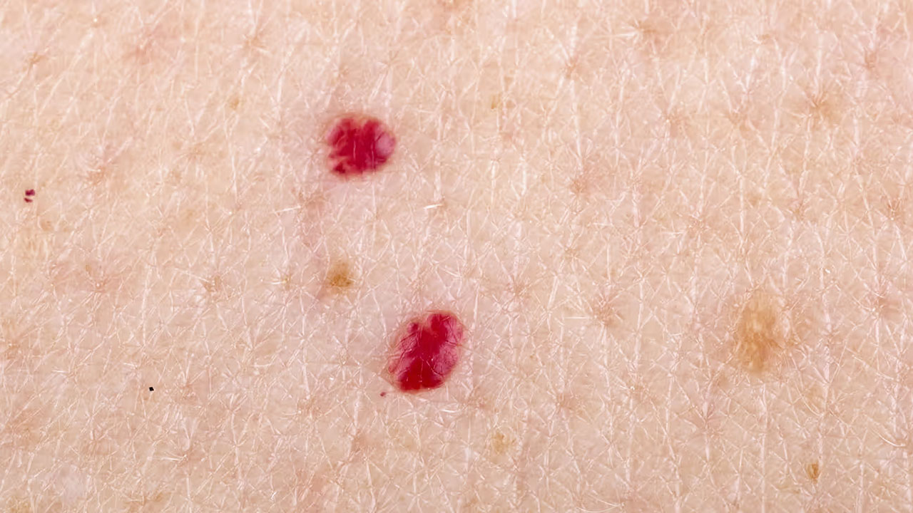 Noticing tiny red dots on your skin? Here's what a dermatologist wants ...