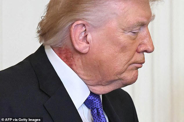Trump sparks new health fears as viewers spot 'nasty' issue on his neck