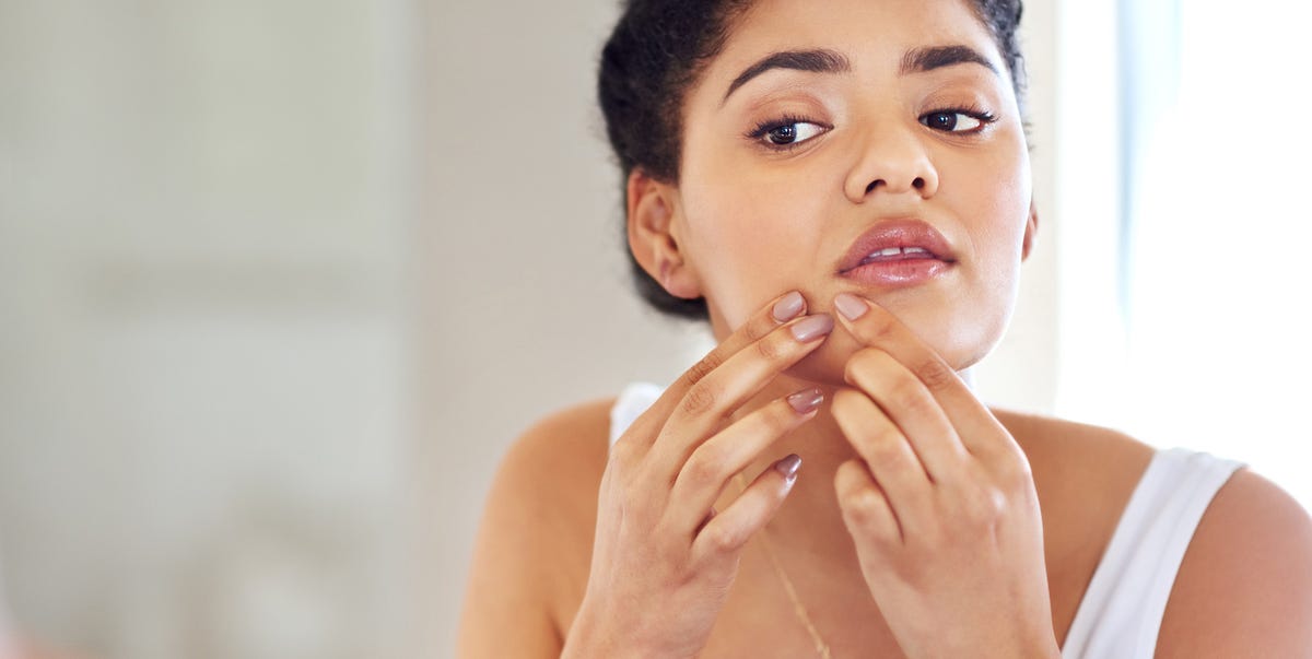 Those 'milk spots' on your skin aren't pimples — they're milia