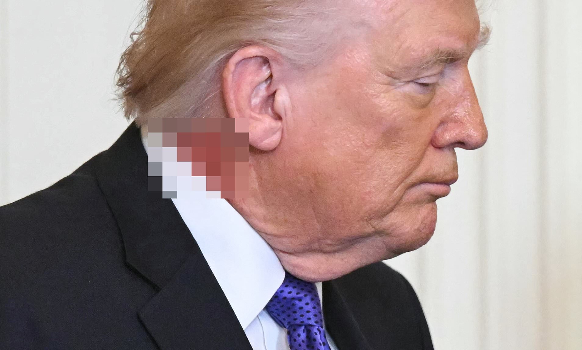 Trump sparks new health fears as viewers spot 'nasty' issue on his neck