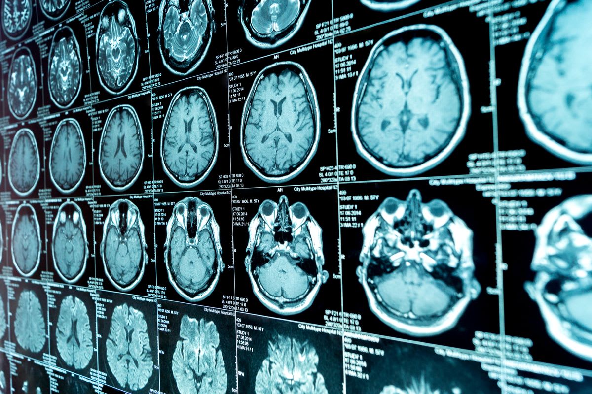 We could be missing a key detail about ADHD: New data suggests there ...