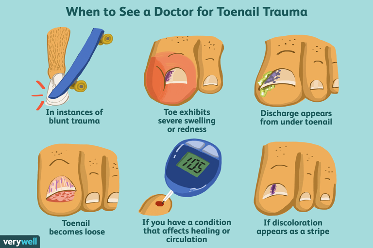 Causes and treatments for a bruised toenail