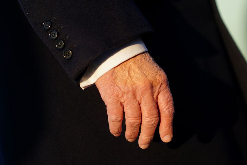 Trump’s hand compared to 'sweet potato grown at Chernobyl' sparking ...