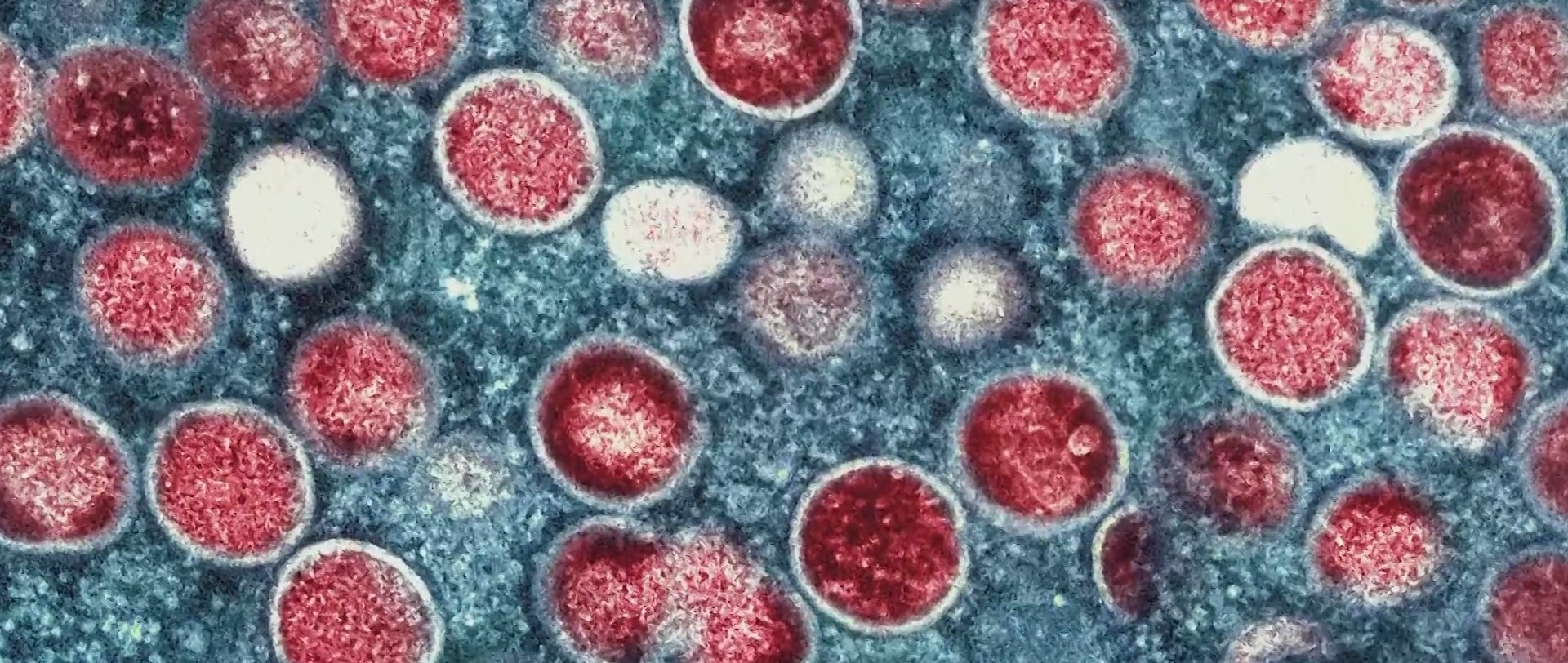First case of severe mpox virus confirmed in NYC, Health Department says