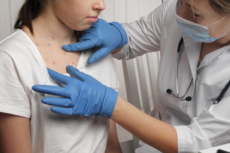Measles exposure reported at grocery store, more in South Carolina: DPH