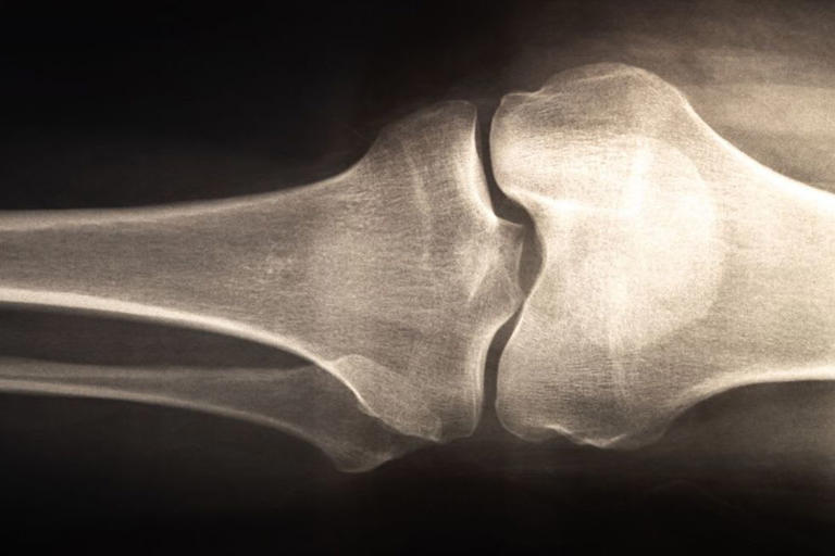 Age-old diet linked to lower risk of bone fractures in osteoporosis study