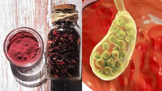Hibiscus powder: A natural remedy for kidney stones