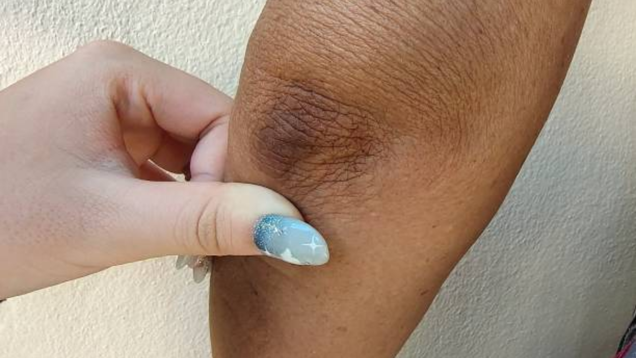 More than diabetes, more than the neck: Where acanthosis nigricans can hide