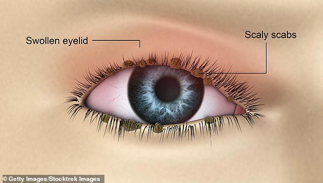 Experts warn that popular eyelash extensions can trigger severe eye ...