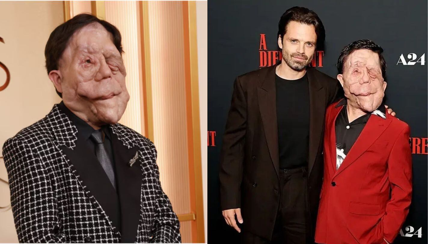 ¿Quién es Adam Pearson y cuál es su enfermedad genética? El actor llamó ...
