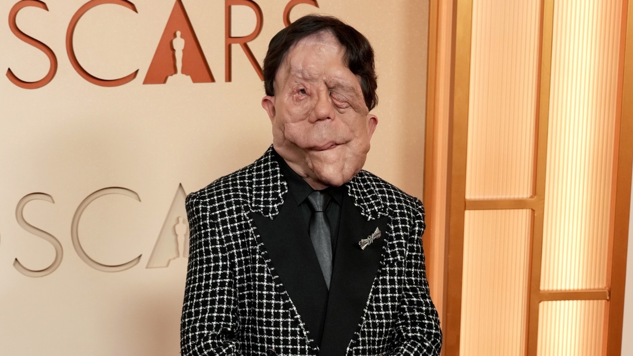 Adam Pearson leva doença genética rara ao centro do debate após ...
