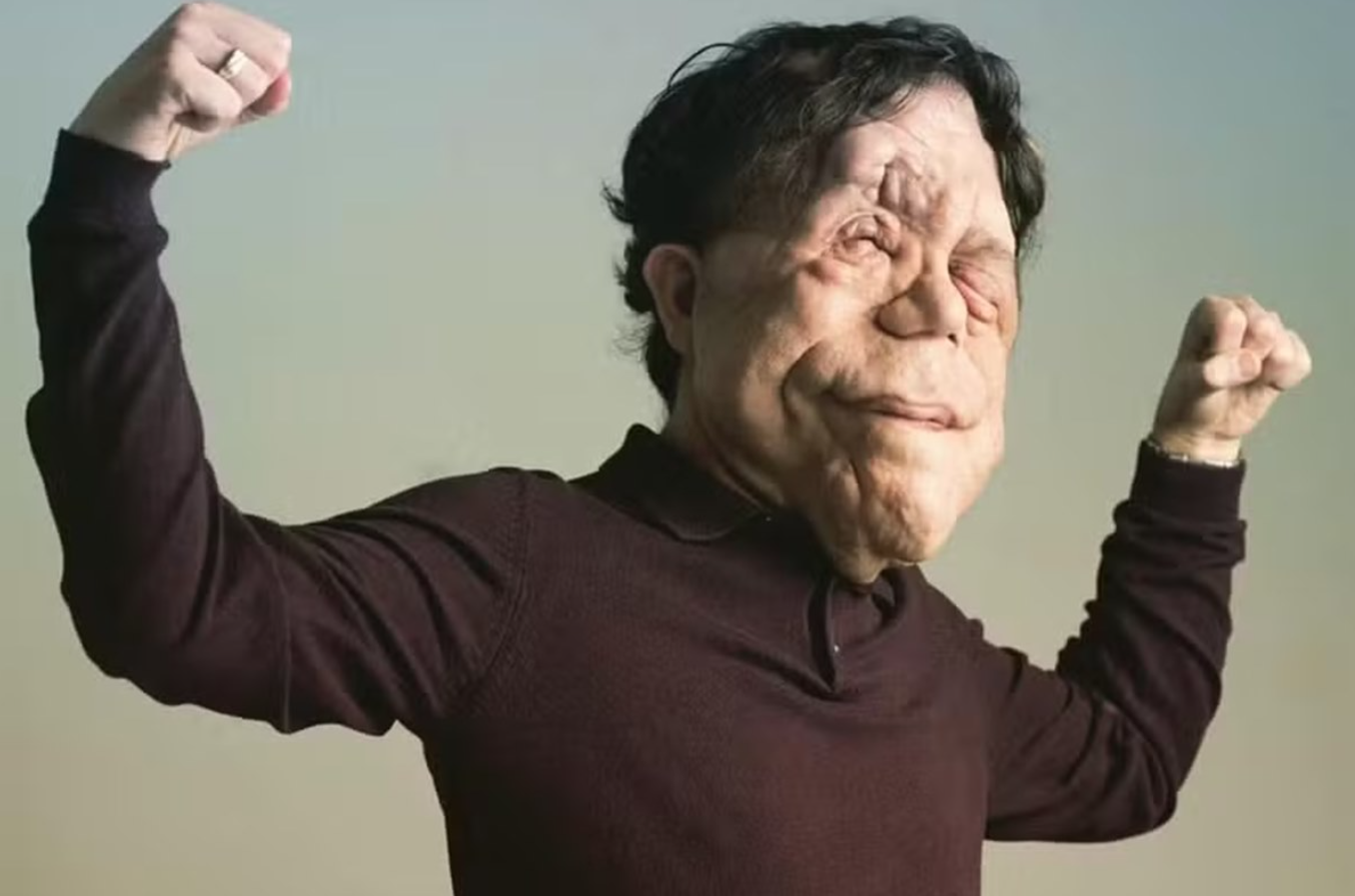 Adam Pearson leva doença genética rara ao centro do debate após ...