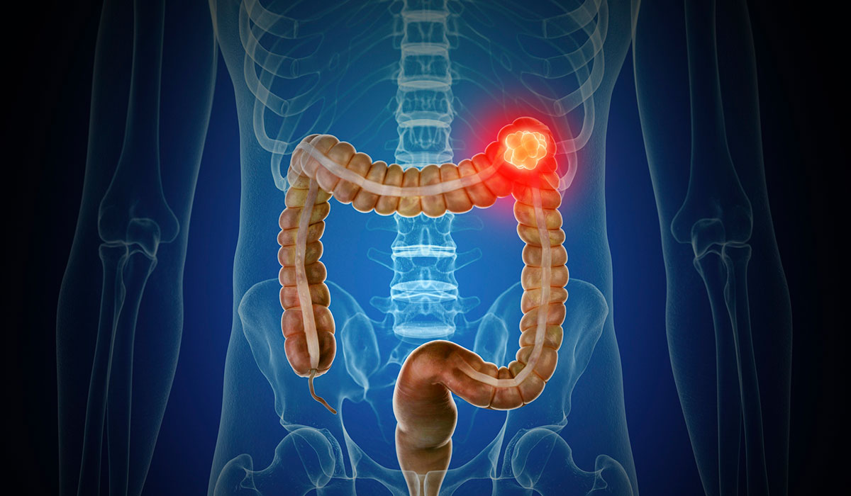 Experts reveal six key signs of bowel cancer as it becomes most deadly ...