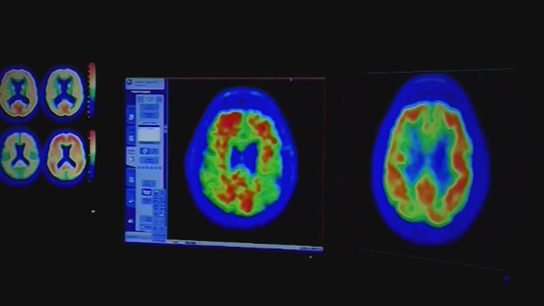 The dream habit that could lead to a higher risk of dementia