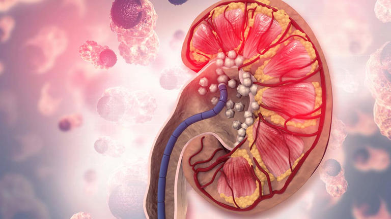 Calcium oxalate kidney stones: Causes, symptoms, diagnosis, treatment ...