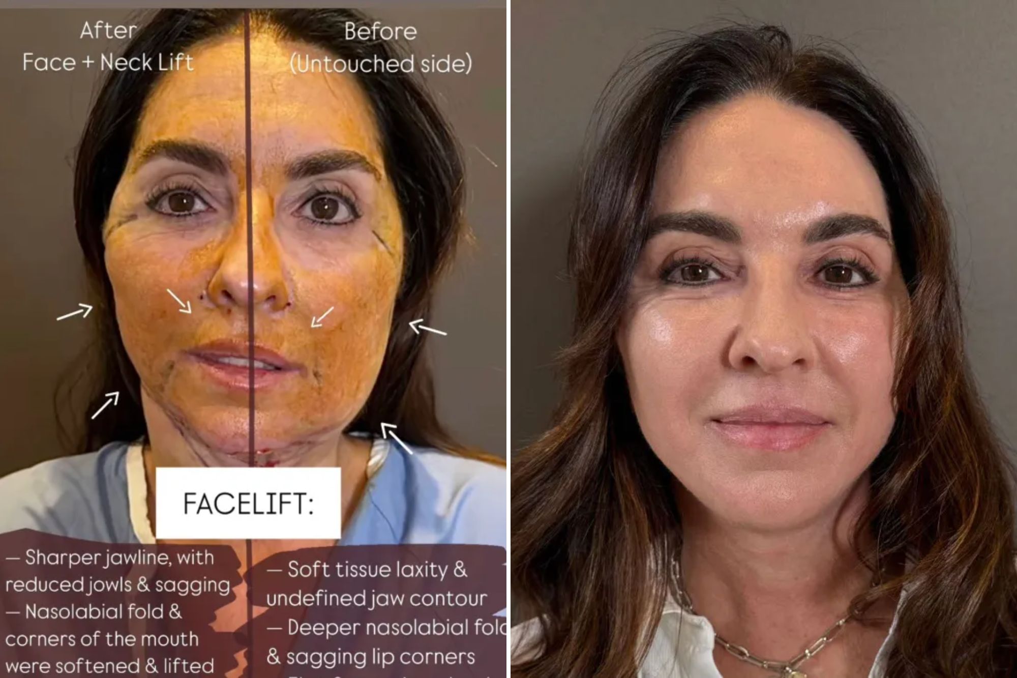Astonishing image shows half-done facelift — as patients embrace new ...