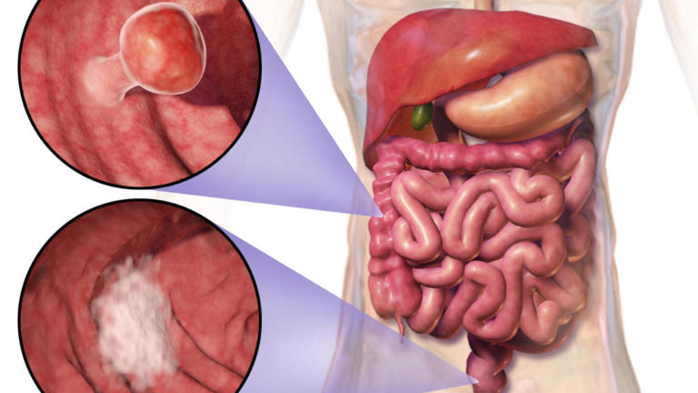 Study: Colorectal cancer is now top cancer killer in Americans under 50