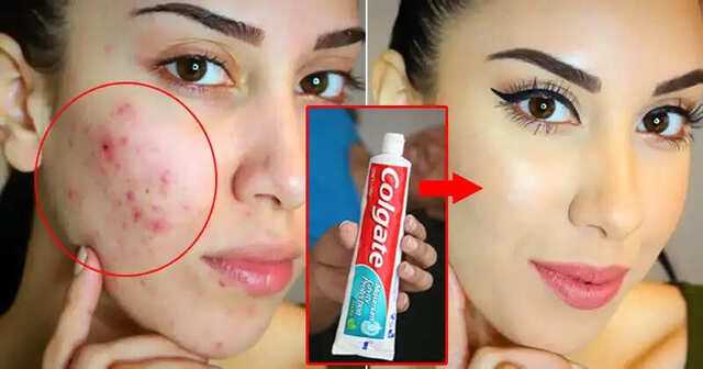 Effective home remedies for quick pimple relief