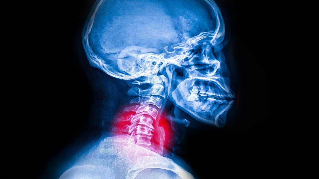 The boxer who fought after breaking his neck