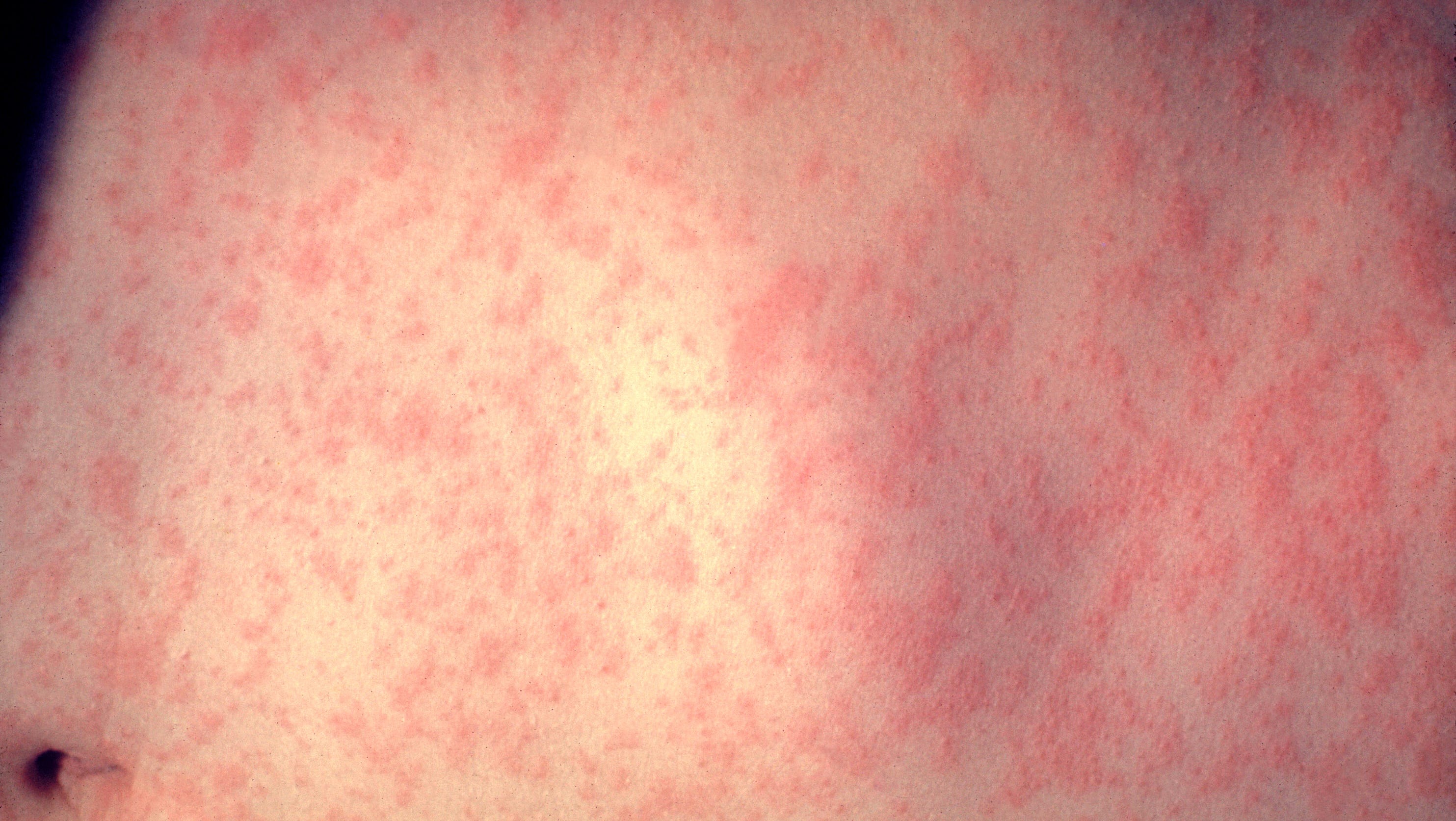 Boston Children's infectious disease expert outlines risks as measles climb