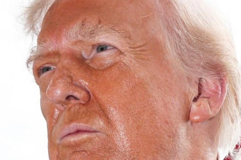 'Radioactive' Trump sparks fears he's had a fall with new bruise above eye