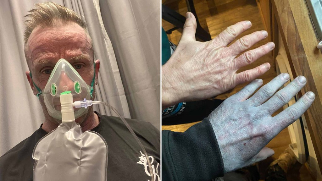 Man took himself to A&E after turning blue – but found out it was dye ...