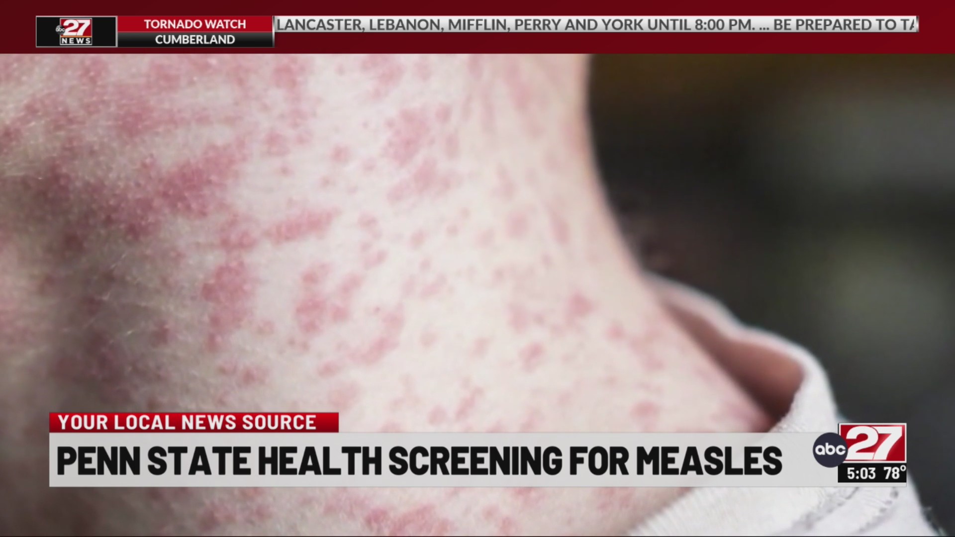 Penn State Health screening for measles
