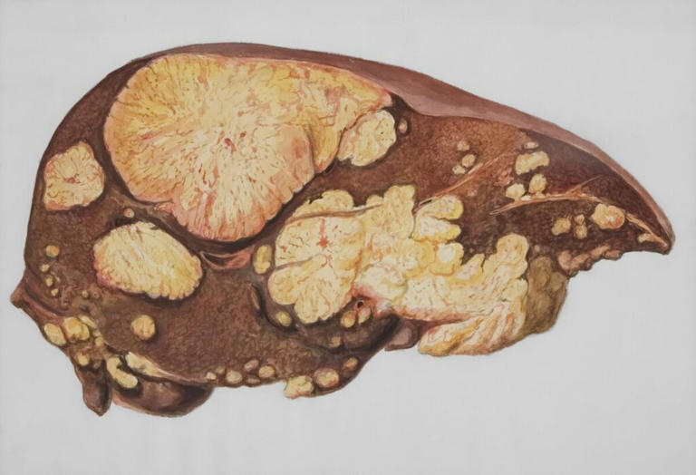 Tumore al pancreas: cos’è, come si cura, la speranza di vita