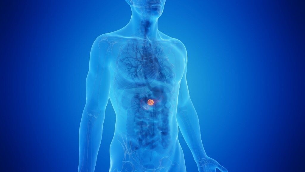 Il tumore al pancreas subdolo e aggressivo, ecco come riconoscerlo