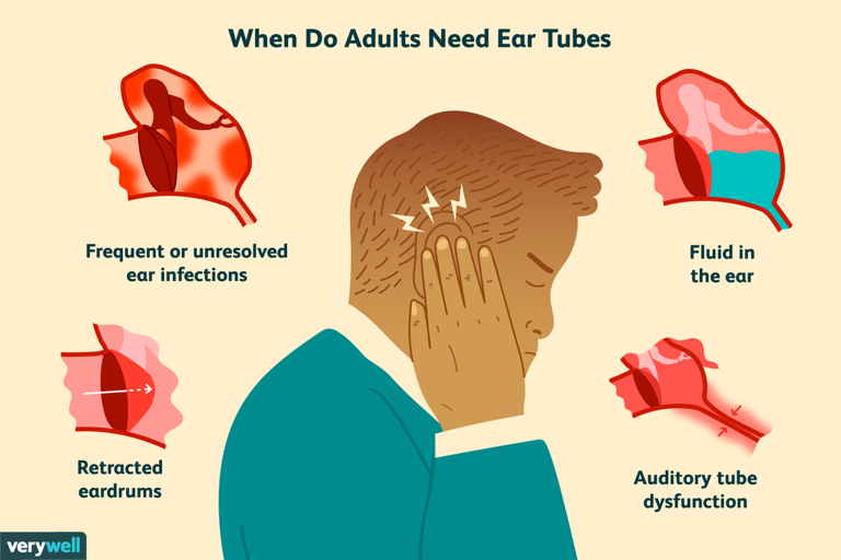 Ear tubes for adults: Everything you need to know