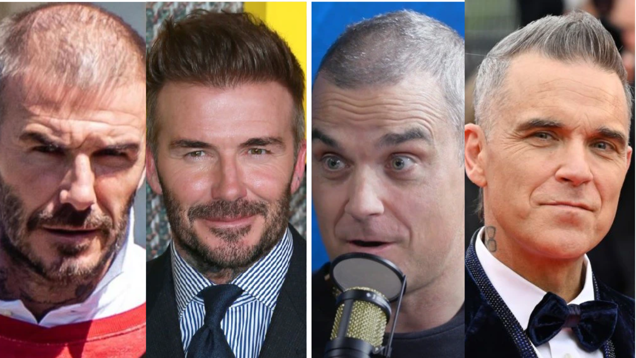 28 male celebrities who got hair transplants