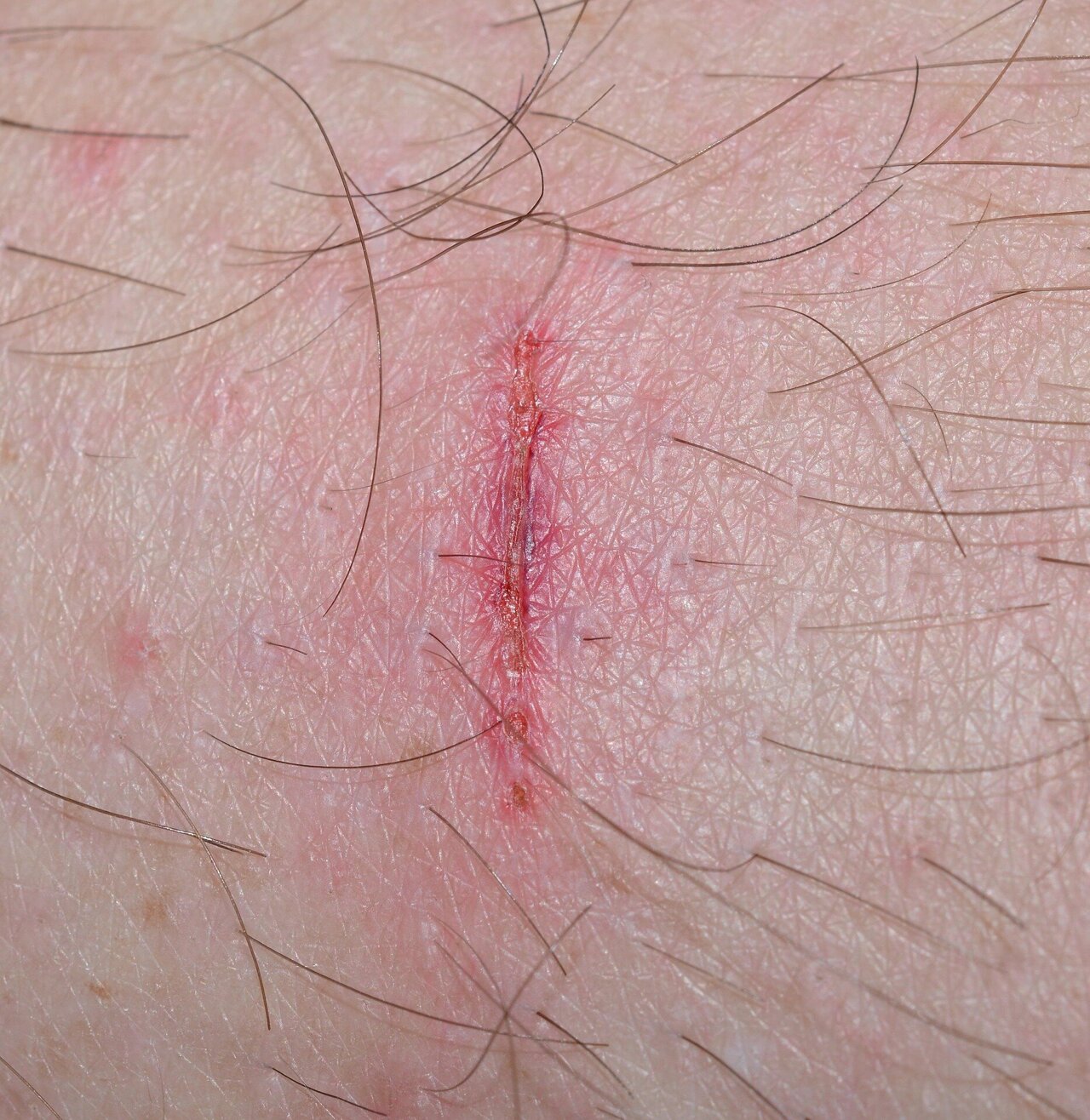 Programmable wound zipper adapts to complex skin injuries, improving ...